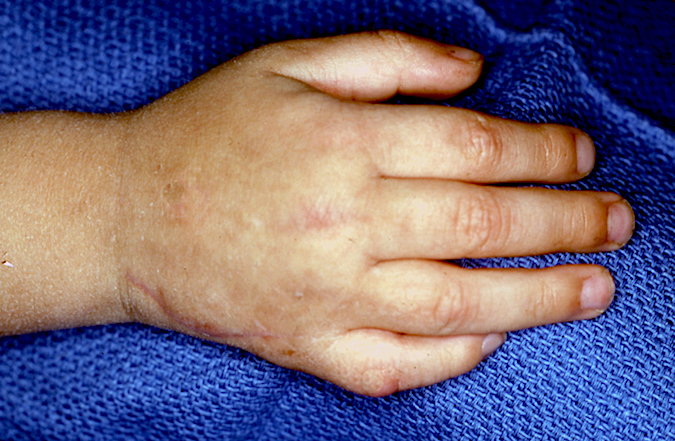 Metacarpal Synostosis Hand Surgery Resource